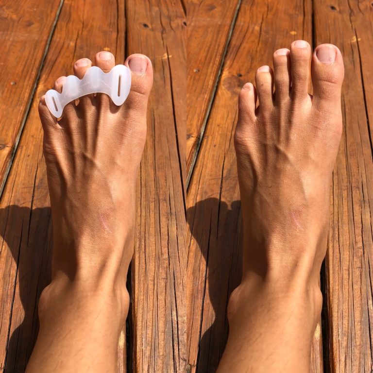 Correct Toes Review - Are They Worth It? | Anya's Reviews