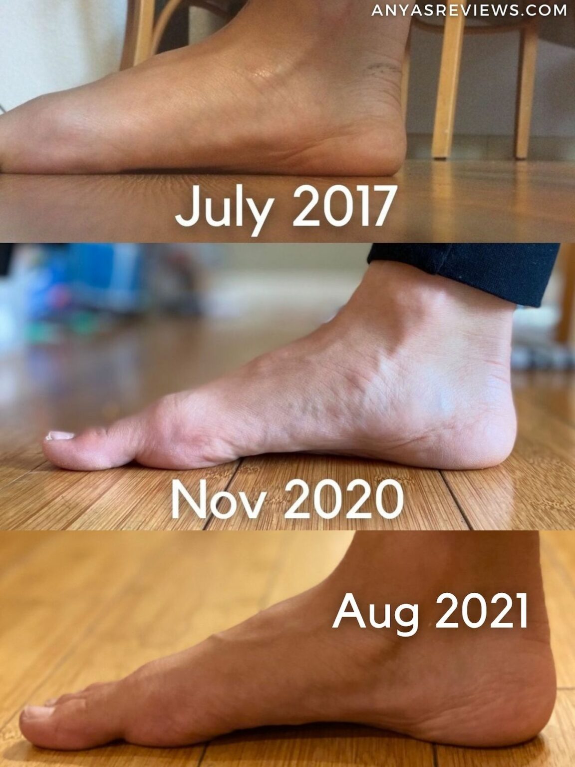 Why Birkenstocks Aren't a Long Term Solution to Foot Pain | Anya's Reviews