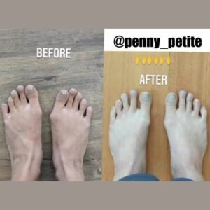 How To Help Your Bunions If You Don't Want Surgery | Anya's Reviews
