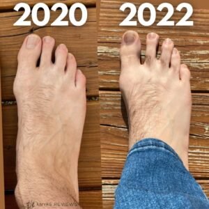 How To Help Your Bunions If You Don't Want Surgery | Anya's Reviews